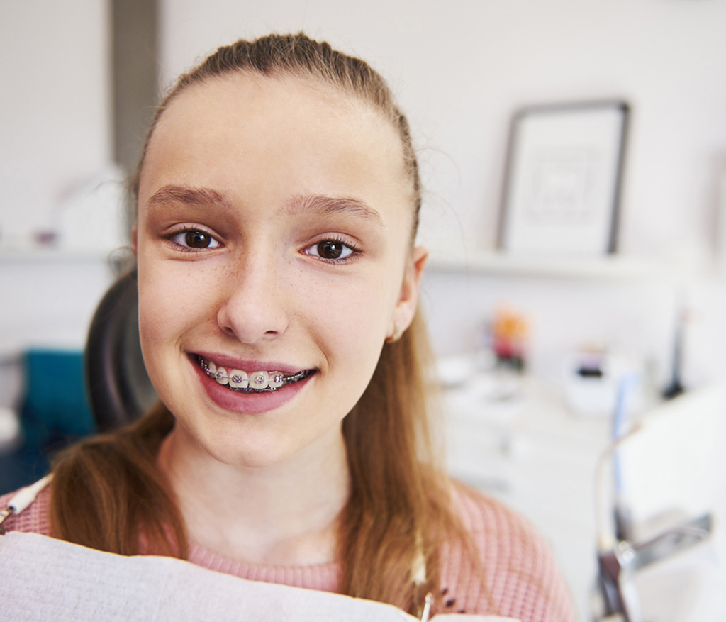 Soirée Kids: When Do Overbites or Underbites Need More Than Braces ...